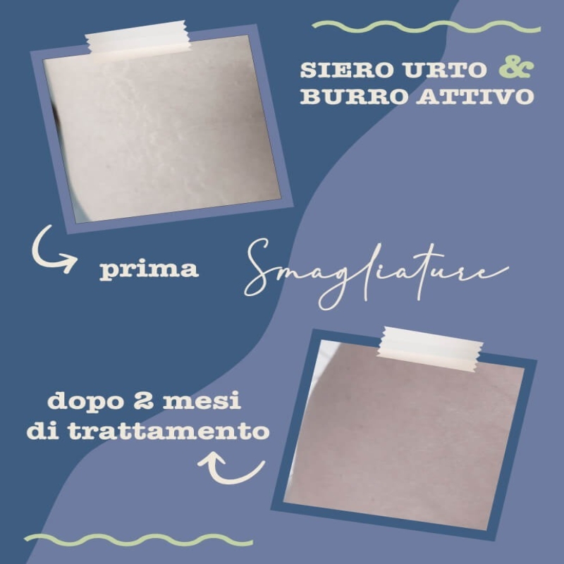 Stretch marks Organic Body Butter - Pregnancy, puberty and weight change